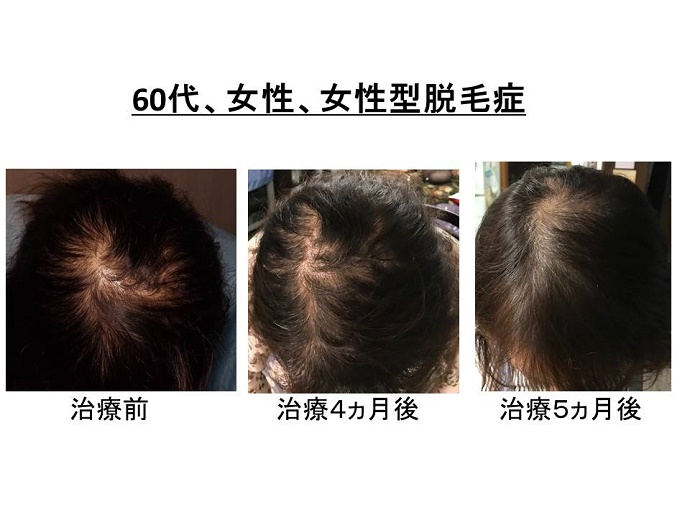 遠隔診療で治療中の、女性型脱毛症の患者様で、効果！脱毛する薬もやめてもらいました。 患者様からの声・メディア掲載・クリニックからのお知らせ